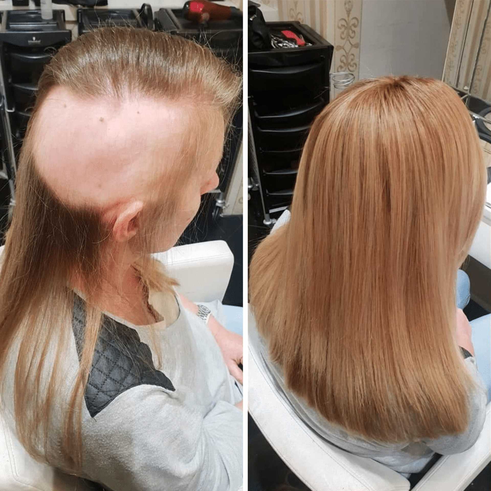 Hairdreams Microlines | Natural Hair Thickening - Hair Loss